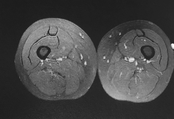 Angiologue.org LIPŒDÈME - HYPERTROPHIE DU TISSU GRAISSEUX -COUPES IRM ...